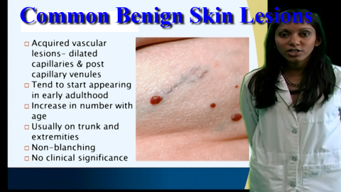 common benign skin lesions Archives - Anatomy Guy