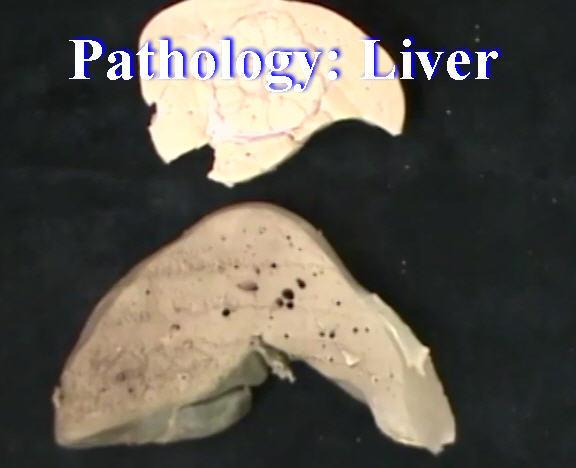 Pathology: Liver - Anatomy Guy