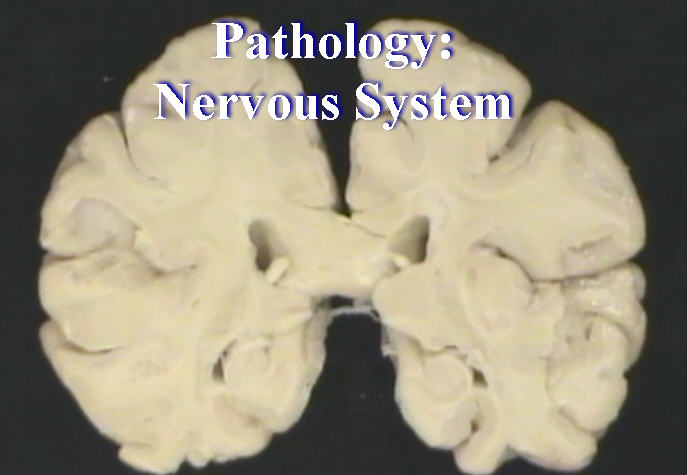 Pathology: Nervous System - Anatomy Guy