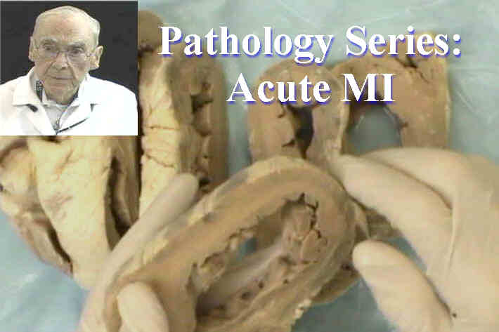 Pathology Review Series: Acute MI - Anatomy Guy