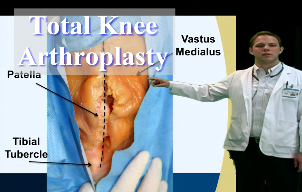Subspecialties: Musculoskeletal - Total Knee Arthroplasty - Anatomy Guy