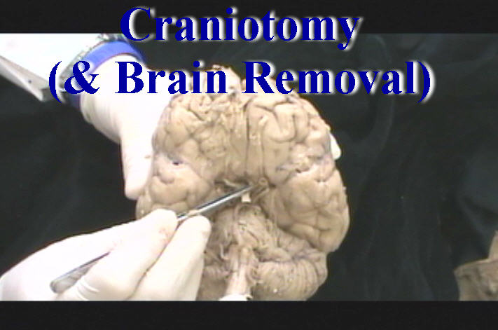 Dissection: Craniotomy & Brain Removal - Anatomy Guy