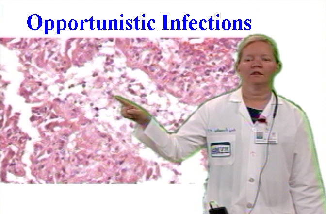 Pathology: Opportunistic Infections - Anatomy Guy