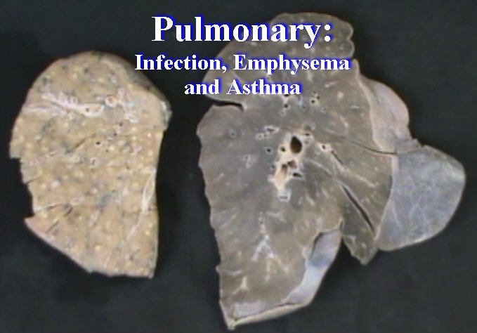 Pathology: Pulmonary - Infection, Emphysema, & Asthma - Anatomy Guy